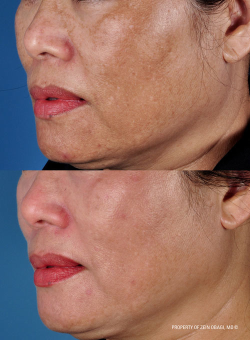 Hyperpigmentation - a common and treatable skin problem - Dr Joanna ...